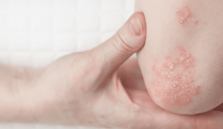 Discoid Psoriasis Pictures Types Of Psoriasis (psoriasis Pictures)