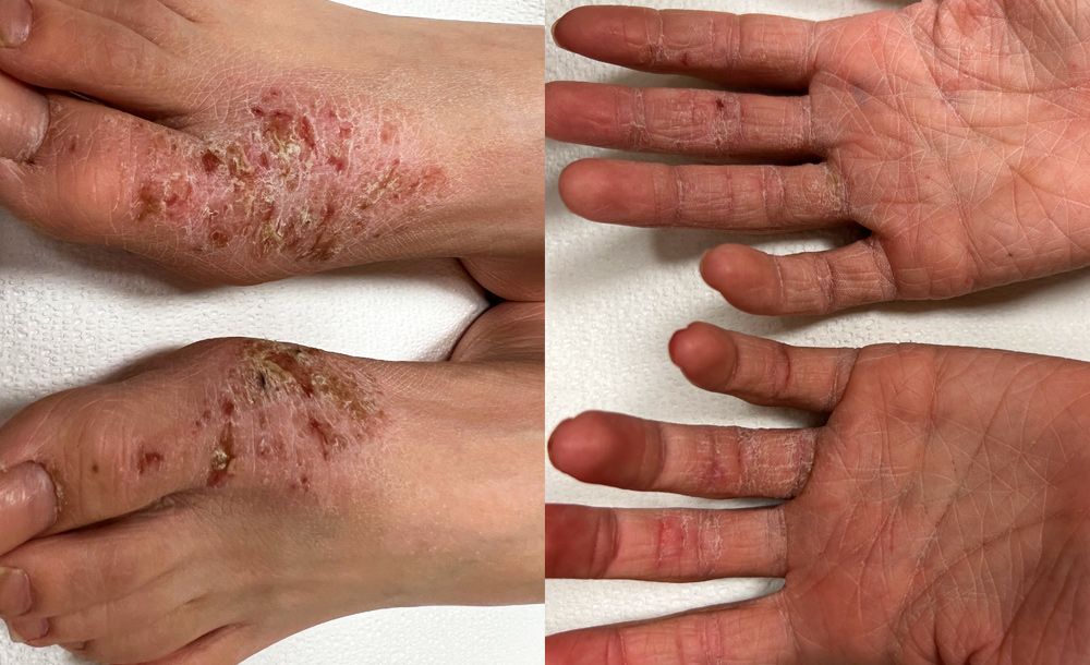 Case Study: Effective Primary Management of Atopic Dermatitis
